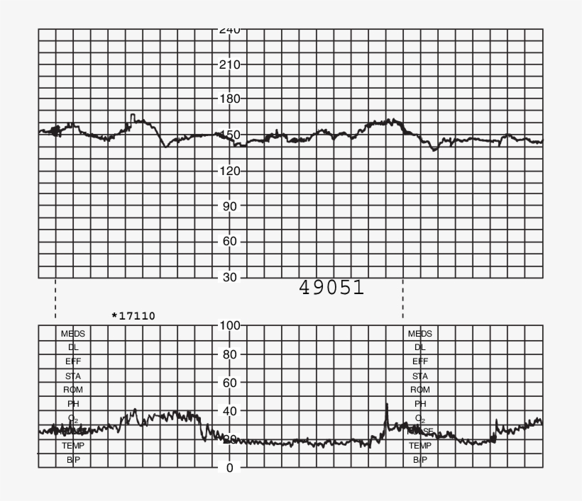 Normal Fetal Heart Rate Pattern - Monacor Airmt-85 Air Motion ...