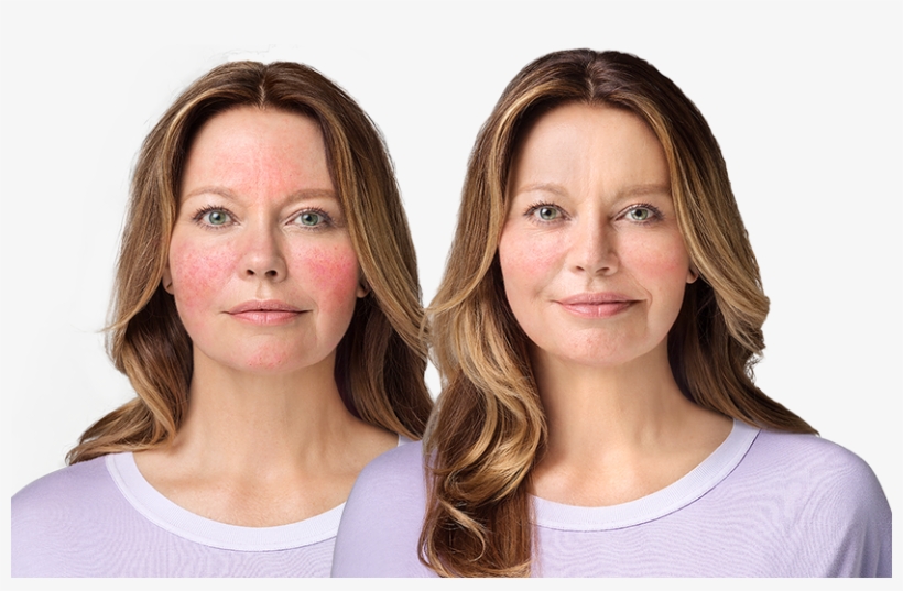 For Persistent Facial Erythema Associated With Rosacea - Before And ...