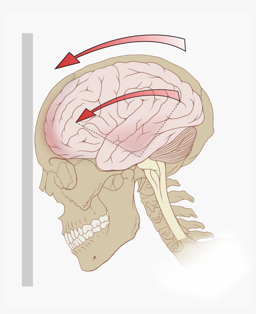 Concussion - Concussion Definition - 2000x2353 PNG Download - PNGkit