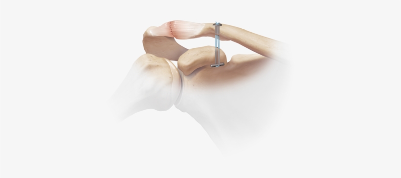 Acromioclavicular Joint Separation 1 Large - Dog Bone Arthrex - 400x370 ...