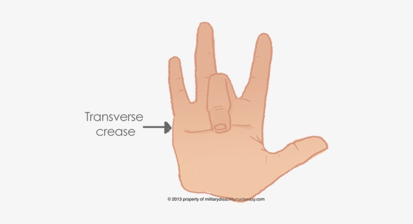Limitation Of Motion Of The Fingers - Sign - 493x365 PNG Download - PNGkit