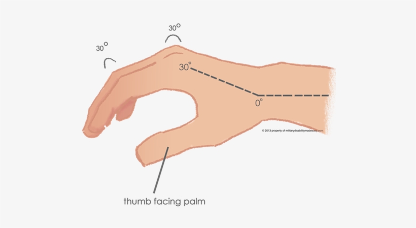 Loss Of Use Of The Fingers - Hand Function Percentage Finger - 504x369 ...