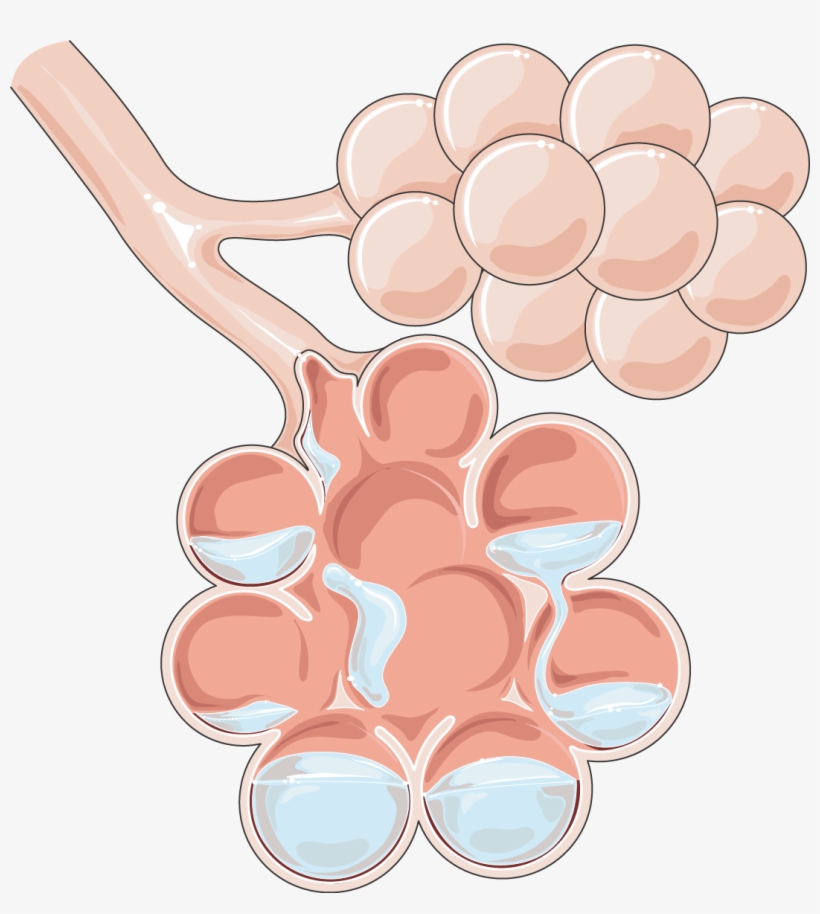 Pulmonary Edema Servier Medical Art Free Images - Pulmonary Edema ...