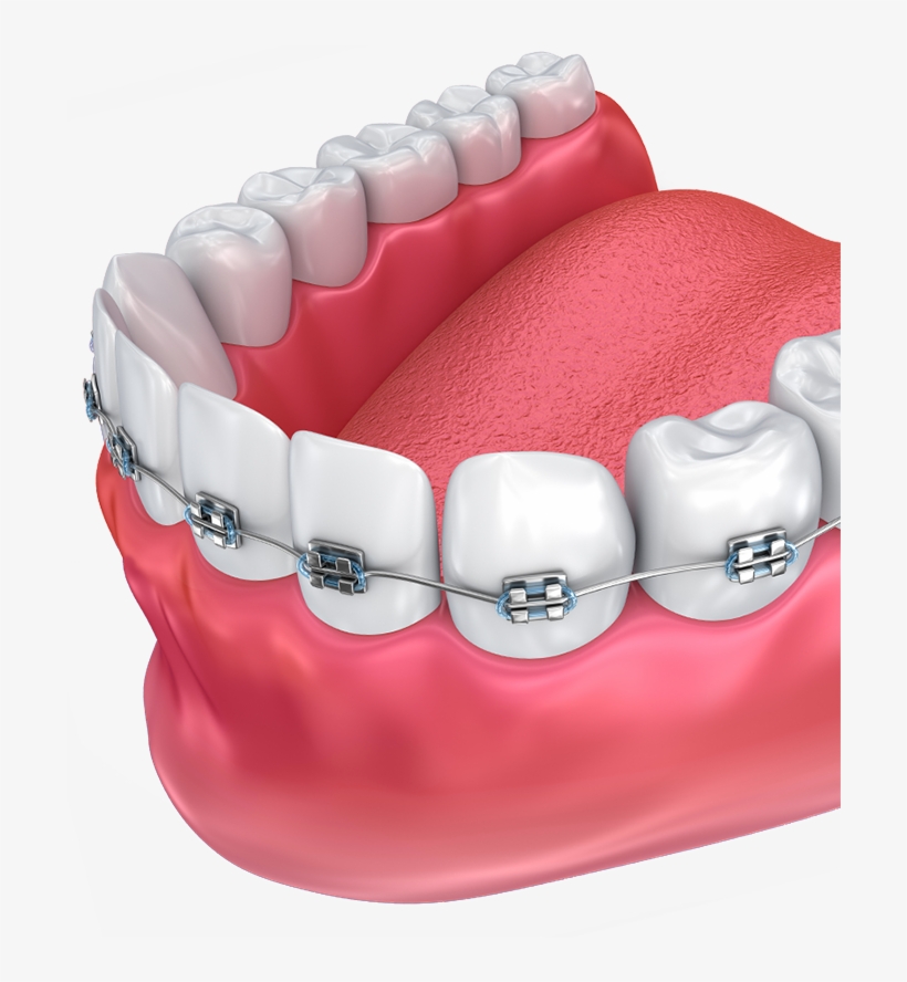 Png Transparent Braces - 700x808 PNG Download - PNGkit