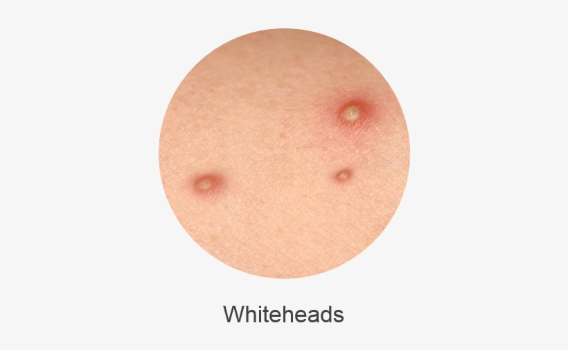 Comprises Blackheads Or Whiteheads Which Result From - Acne Transparent ...