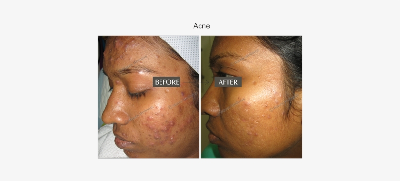 Acne - 420x291 PNG Download - PNGkit