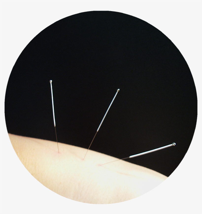 Acupuncture Is The Insertion Of Fine, Single-use Needles - Circle ...