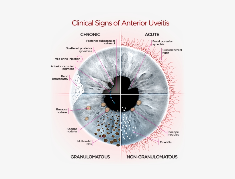 Optometry School, Anatomia Ocular, Globo Ocular, Autoimmune - Signs Of ...