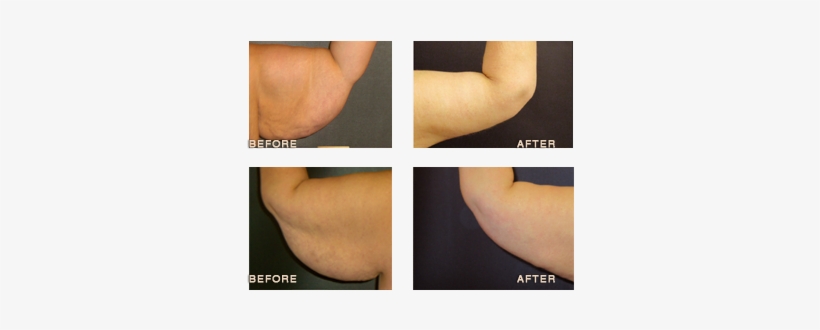 Brachioplasty And Liposuction - Bodybuilding - 502x249 PNG Download ...