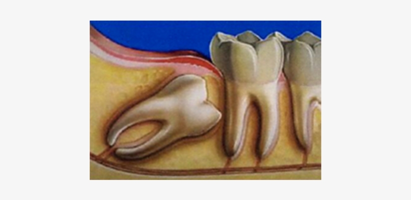 Wisdom Teeth - Wisdom Tooth - 960x800 PNG Download - PNGkit