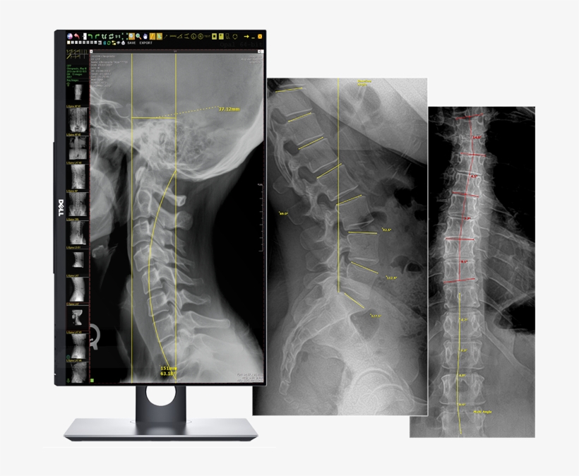 Opal-chiro Software - Digital Radiography - 720x600 PNG Download - PNGkit