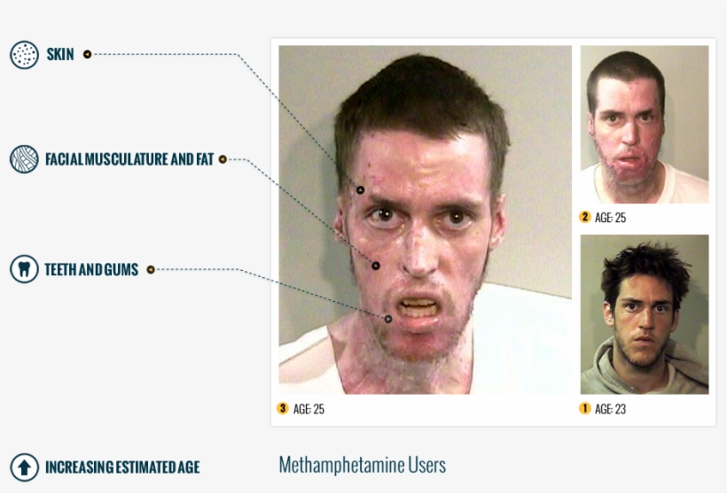 The Affects Of Meth - Meth Addict - 916x678 PNG Download - PNGkit