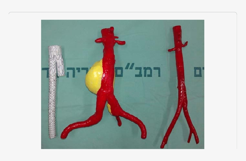 3d Models In Evar Planning - Endovascular Aneurysm Repair - 761x458 PNG ...