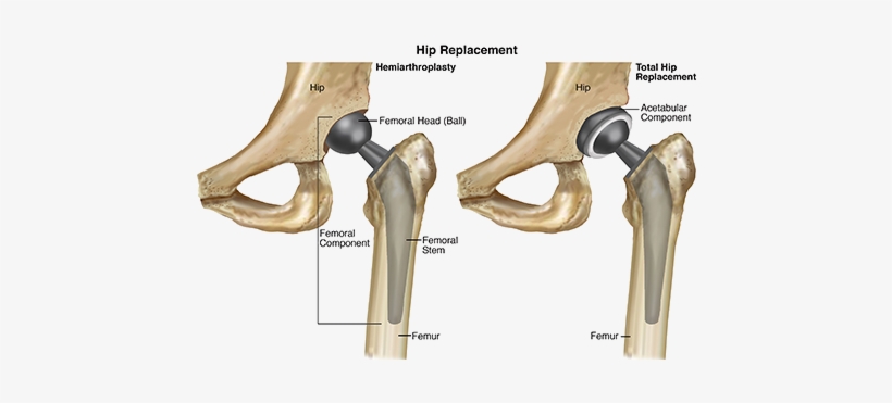 Hemiarthroplasty Vs Total Hip Replacement - 500x300 PNG Download - PNGkit