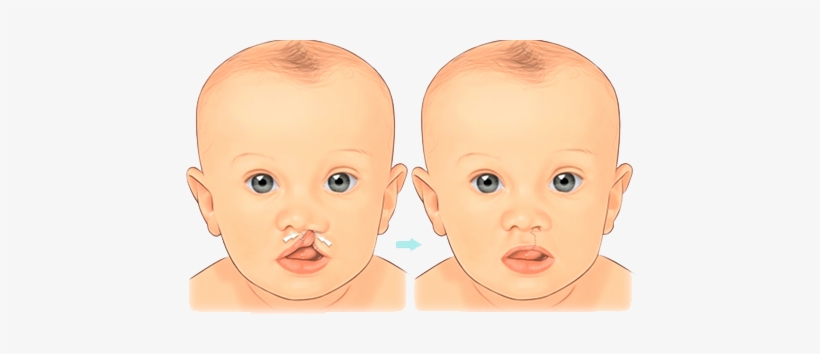 Association - Cleft Lip And Palate Before - 455x274 PNG Download - PNGkit