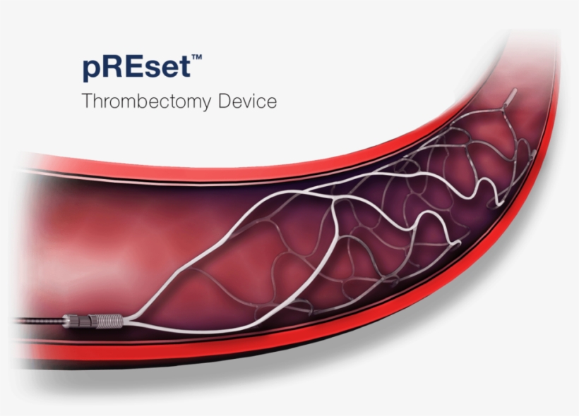 Phenox-preset Thrombectomy Device - Diagram - 1000x682 PNG Download ...