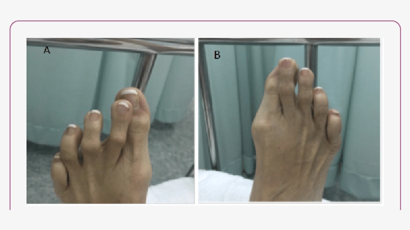 The Presence Of Crossover Second Toe Deformity On Both - Barefoot ...