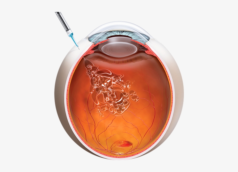 Anti-vegf Injection - Intravitreal Gas Injection - 600x635 PNG Download ...