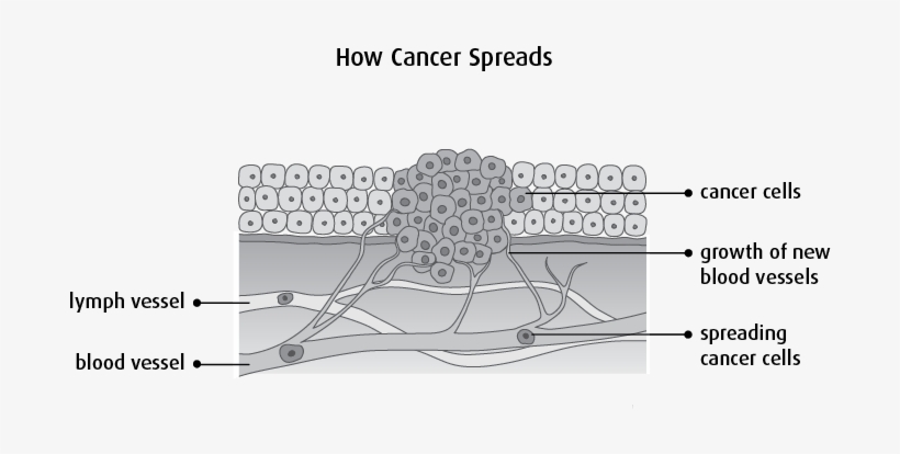 Diagram Of How Cancer Spreads - Comment Le Cancer Se Developpe ...