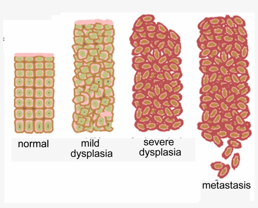 Progressive Increases In Cell Division And Abnormal - Cancer Cell ...