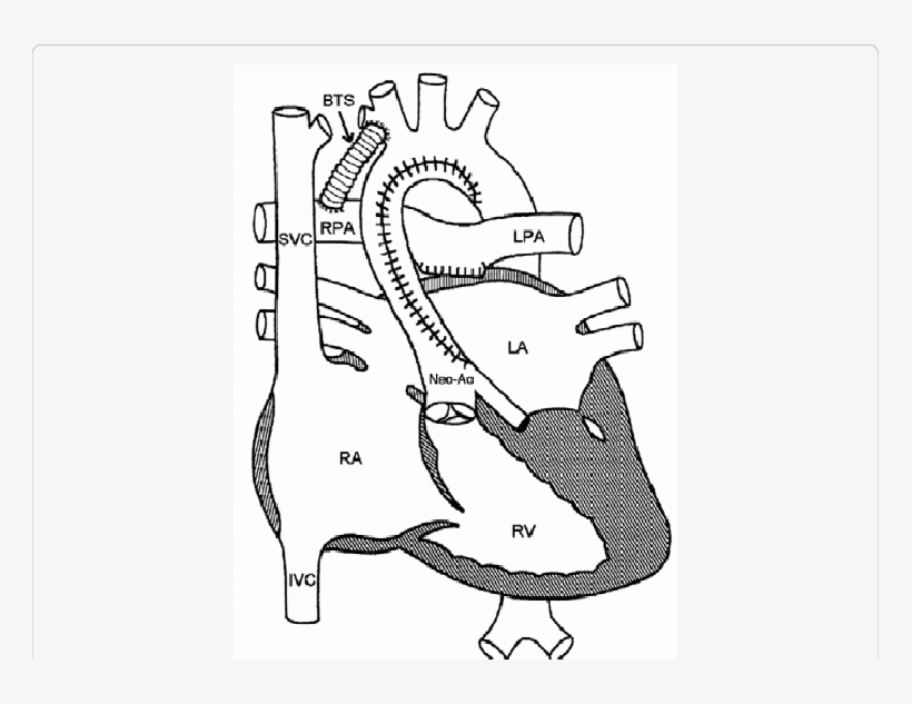 In Stage I, Norwood Procedure, The Pulmonary Artery - 761x553 PNG ...