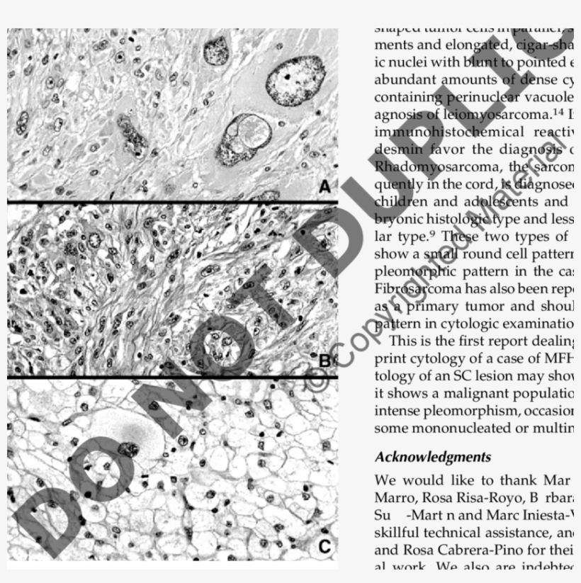 Neoplastic Proliferation Of Atypical Cells With High - Zellballen ...