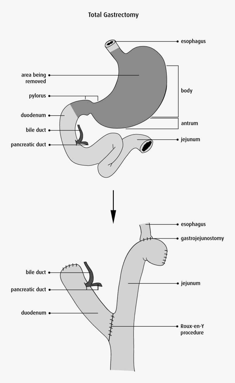 Lymph Node Dissection - Diagram - 744x1258 PNG Download - PNGkit