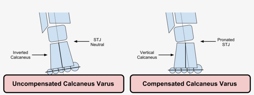 Joint Thumb Cartoon Image Gait - Compensated Rearfoot Varus - 1956x659 ...