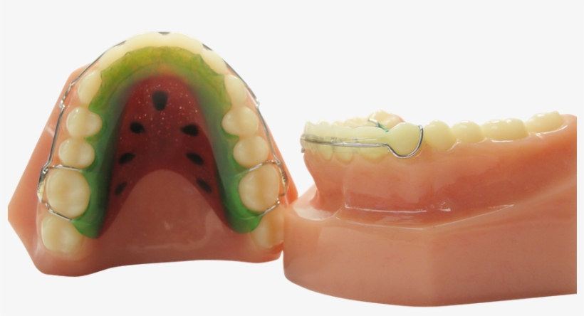 Hawley Retainer With Labial Bow Soldered To Adams Clasps - Retainer ...