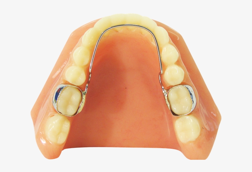 Nance Appliance - Llha Orthodontic Appliance - 623x500 PNG Download ...