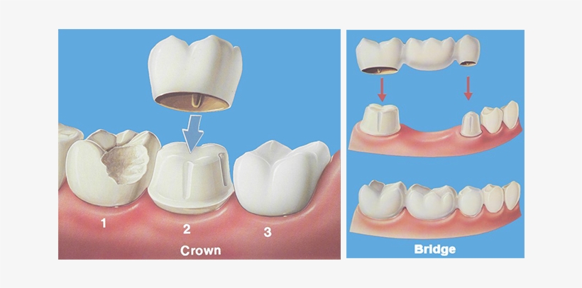 Crown-bridge - 949x333 PNG Download - PNGkit
