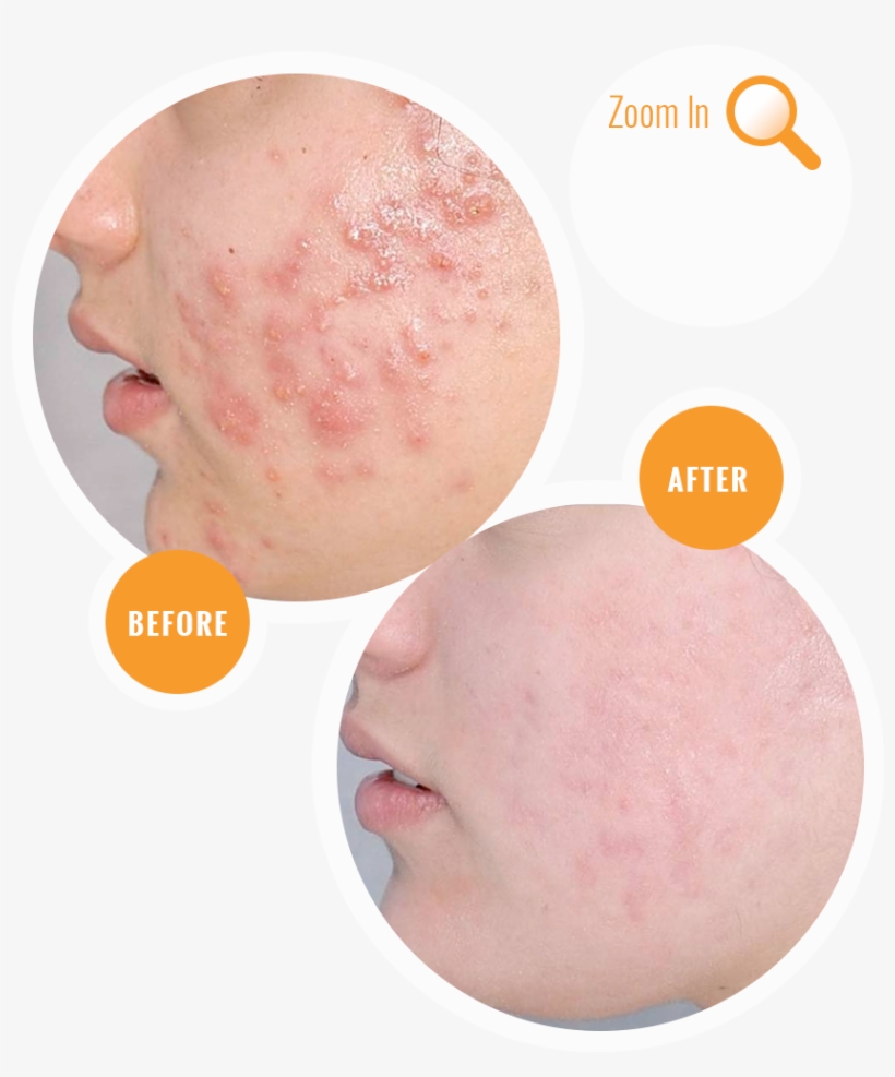 Acne Before And After Treatment - Acne Transparent - 853x976 PNG ...