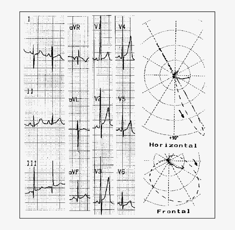 Electro And Vectorcardiogram Revealing Right Ventricular - Diagram ...