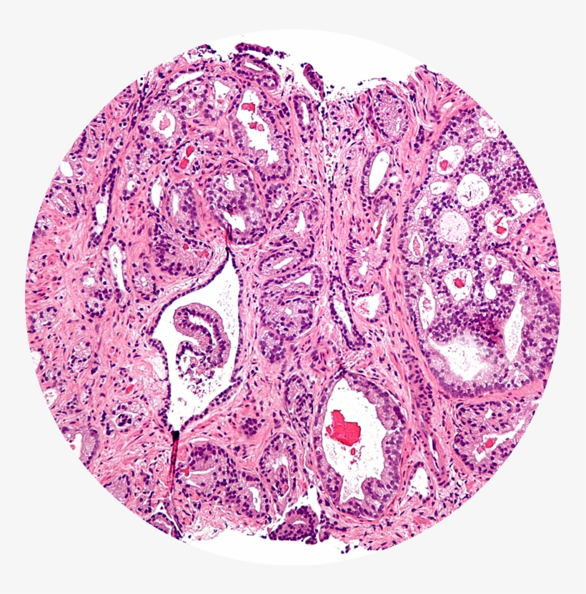 Tissue Cancer - 800x800 PNG Download - PNGkit