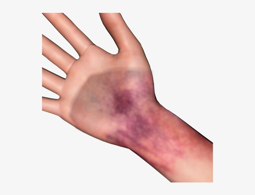 Bruise Photosymbols - Human Leg - 600x600 PNG Download - PNGkit