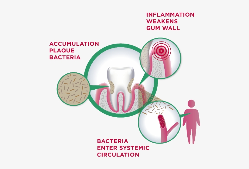 The Gum Link - Diagram - 670x529 PNG Download - PNGkit