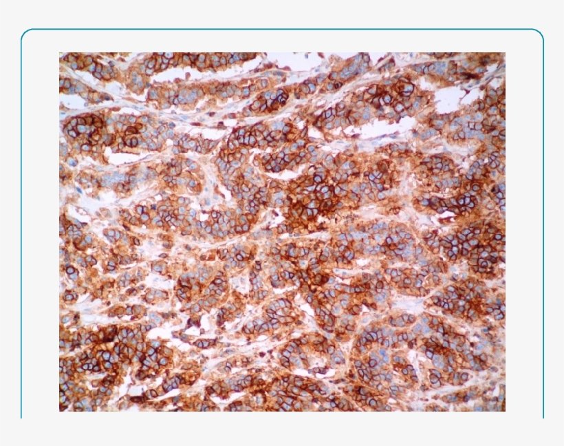 Cd 56 Stain Show Diffuse Strong Cytoplasmic Staining - Dessert ...