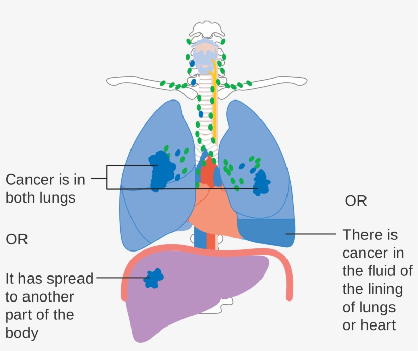 Download Transparent Tnm Staging Lung Cancer - PNGkit