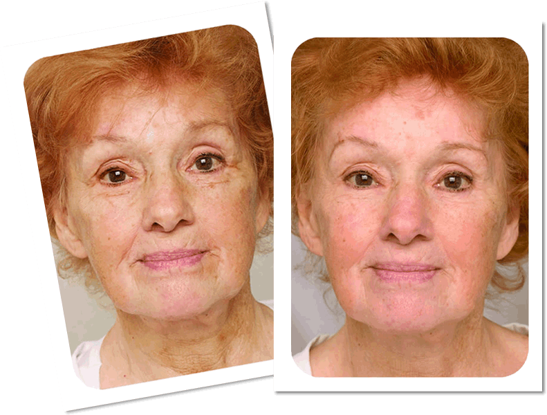 Download Before And After Laser Anti-wrinkle Treatment - Collage - Full ...