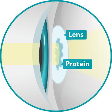 Download Cataracts Occur When The Lens In Your Eye Becomes Cloudy ...