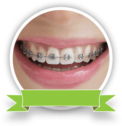 Download Braces - Dental Braces - Full Size PNG Image - PNGkit