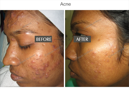 Download Acne - Full Size PNG Image - PNGkit