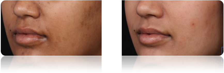 Download Acne - Plastic Surgery - Full Size PNG Image - PNGkit