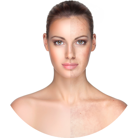 Download Transparent Freckles Are Also Known As Ephelis And Appear As ...