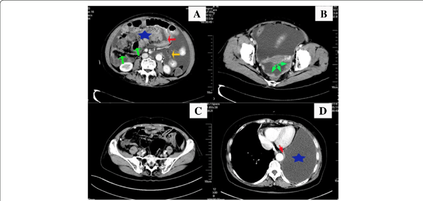 Download A Intravenous And Oral Contrast-enhanced Ct Scan Shows ...
