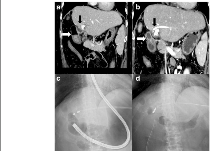 Download A Computed Tomography Showed The Bulbus Duodeni And - Bile ...