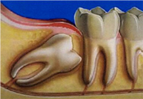 Download Wisdom Teeth - Wisdom Tooth - Full Size PNG Image - PNGkit