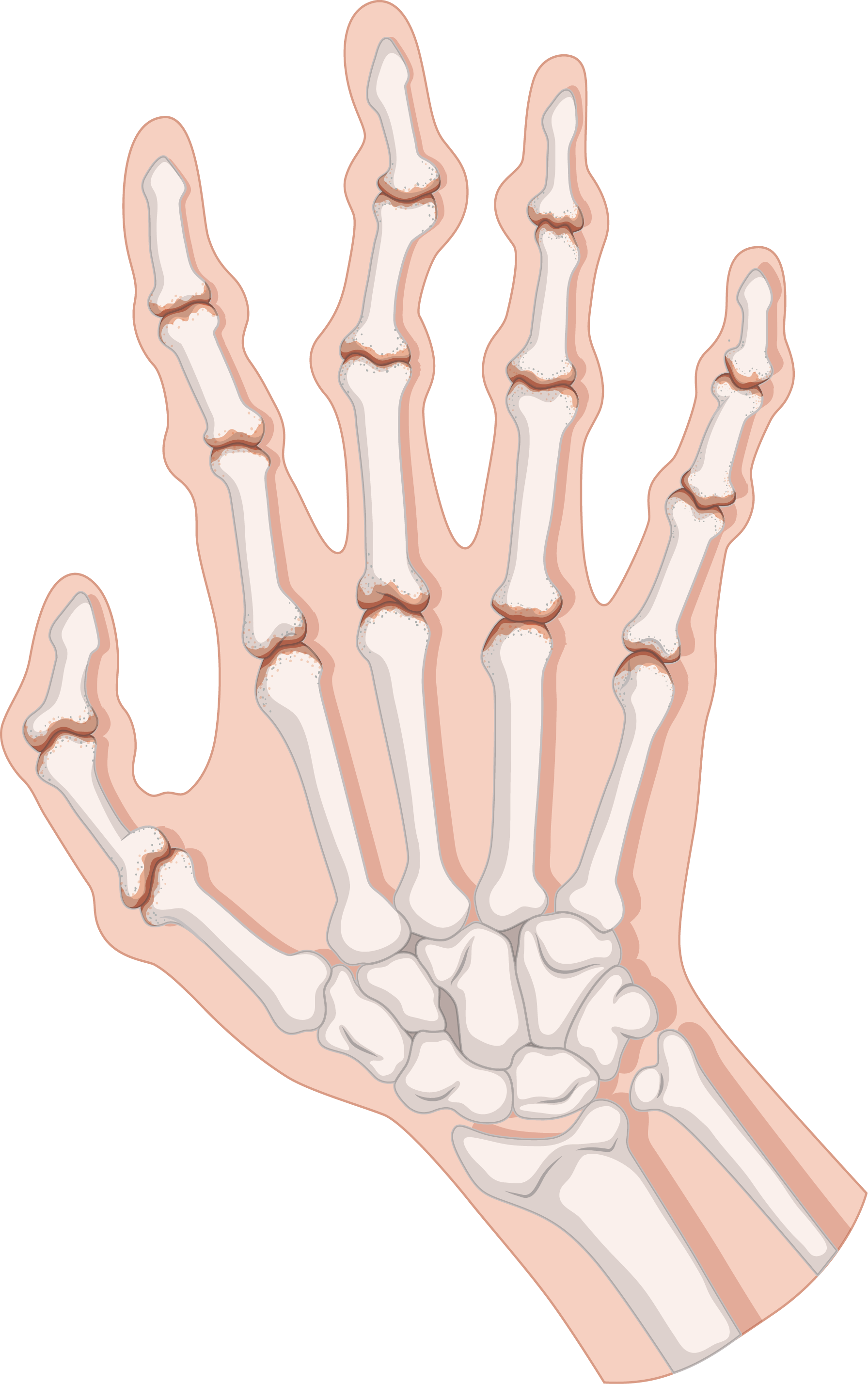 Download Rheumatoid Arthritis Clip Art - Arthritis Clipart - Full Size ...