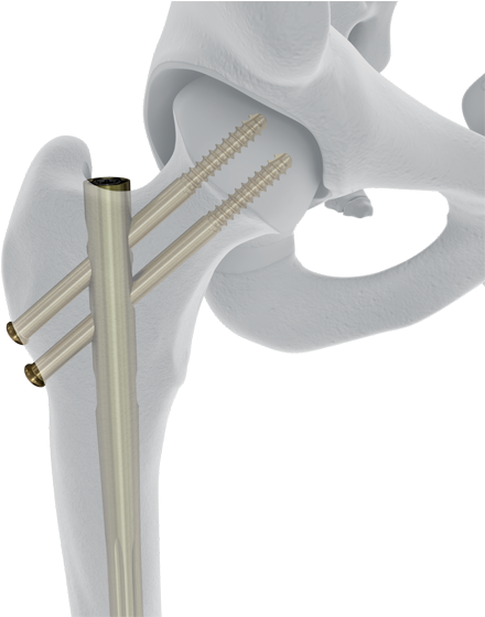 Download Femoral Recon Nail Implanted - Depuy Synthes Companies - Full ...