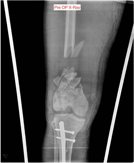 Download 21-year Old Male With Compound C3 Fracture Of The Right - Bone ...